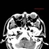 Facial Fracture Induced Periorbital Emphysema - JETem