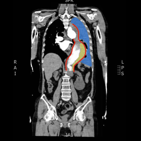 Intramural Hematoma with Type B Aortic Dissection - JETem