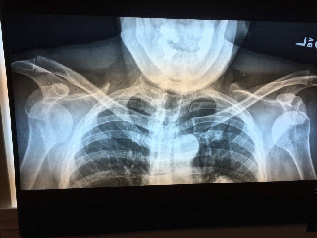 Bilateral Shoulder Dislocation. XR. JETem 2019 - JETem