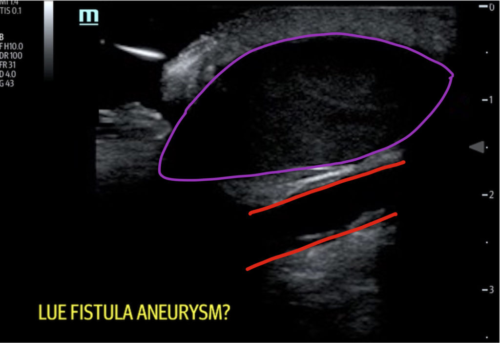 LUE AV Graft Pseudoaneurysm Annotated. JETem 2019 - JETem