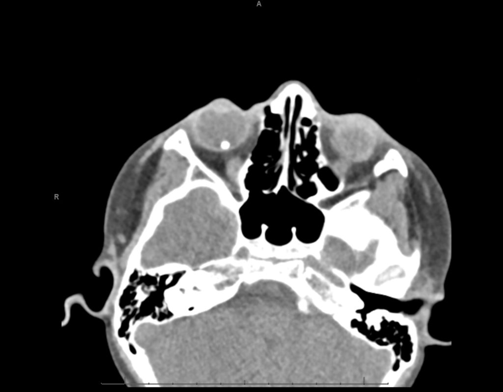 Open Globe with Intraocular Foreign Body, CT Axial. JETem 2019 - JETem