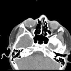 Open Globe with Intraocular Foreign Body - JETem