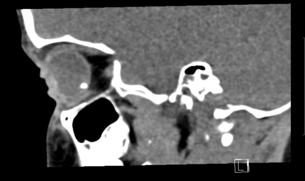 Open Globe with Intraocular Foreign Body - JETem