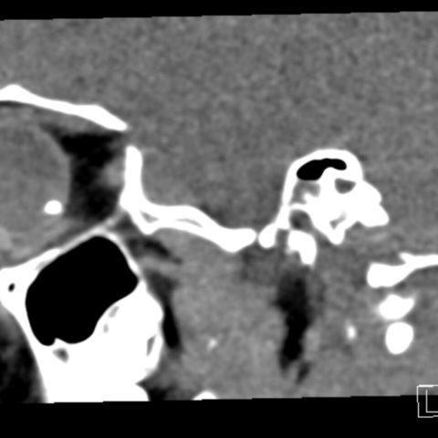 Open Globe with Intraocular Foreign Body - JETem