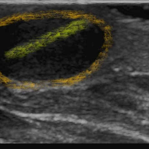 Radiolucent Foreign Body Seen on Point-of-Care Ultrasound but not on X ...