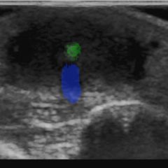 Radiolucent Foreign Body Seen on Point-of-Care Ultrasound but not on X ...