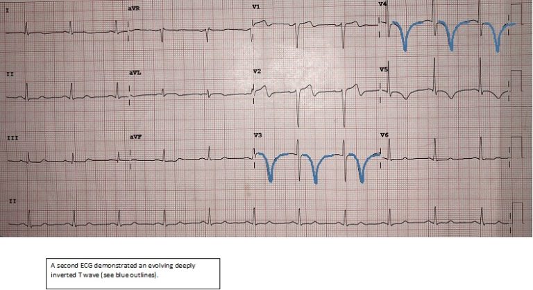 Wellen's Syndrome. ECG 2, annotated. JETem 2019 - JETem