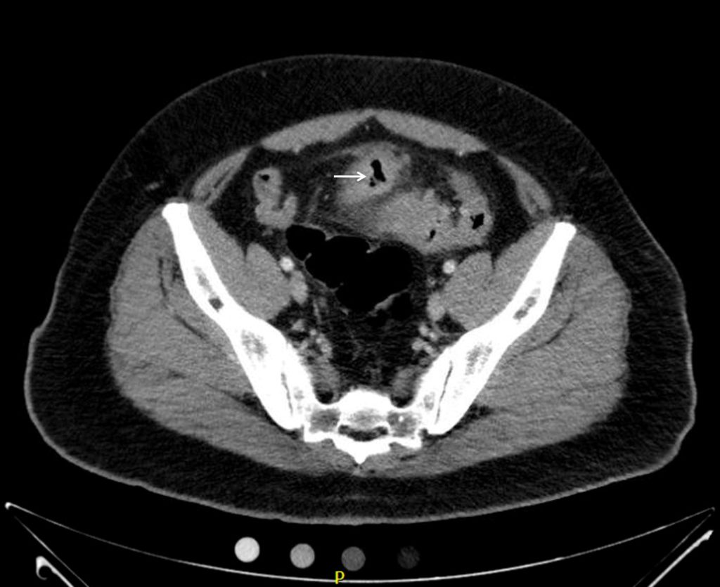 Colovesical Fistula, Axial CT, Figure 1 Annotated. JETem 2019 - JETem