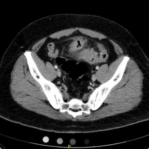 Sigmoid Diverticulitis Complicated by Colovesical Fistula Presenting ...