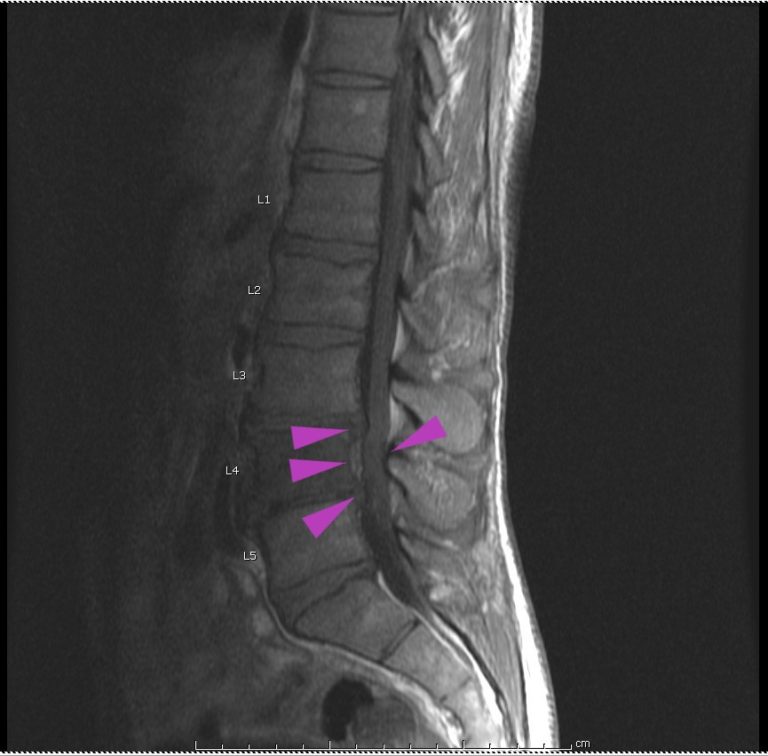 Erectile Dysfunction As A Presenting Symptom For Renal Cell Carcinoma Mri Lateral Annotated
