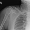 Shoulder dislocation: Lightbulb sign, Chest X-ray and Post-Reduction ...