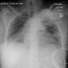 Shoulder dislocation: Lightbulb sign, Chest X-ray and Post-Reduction ...