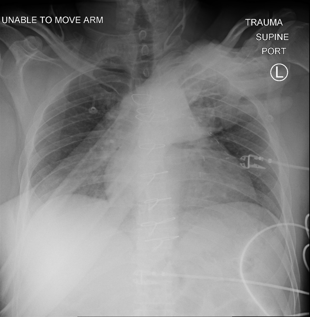Shoulder Dislocation Lightbulb Sign Chest X ray And Post Reduction Shoulder Dislocation Lightbulb Sign Chest X ray And Post Reduction