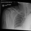 Shoulder dislocation: Lightbulb sign, Chest X-ray and Post-Reduction ...