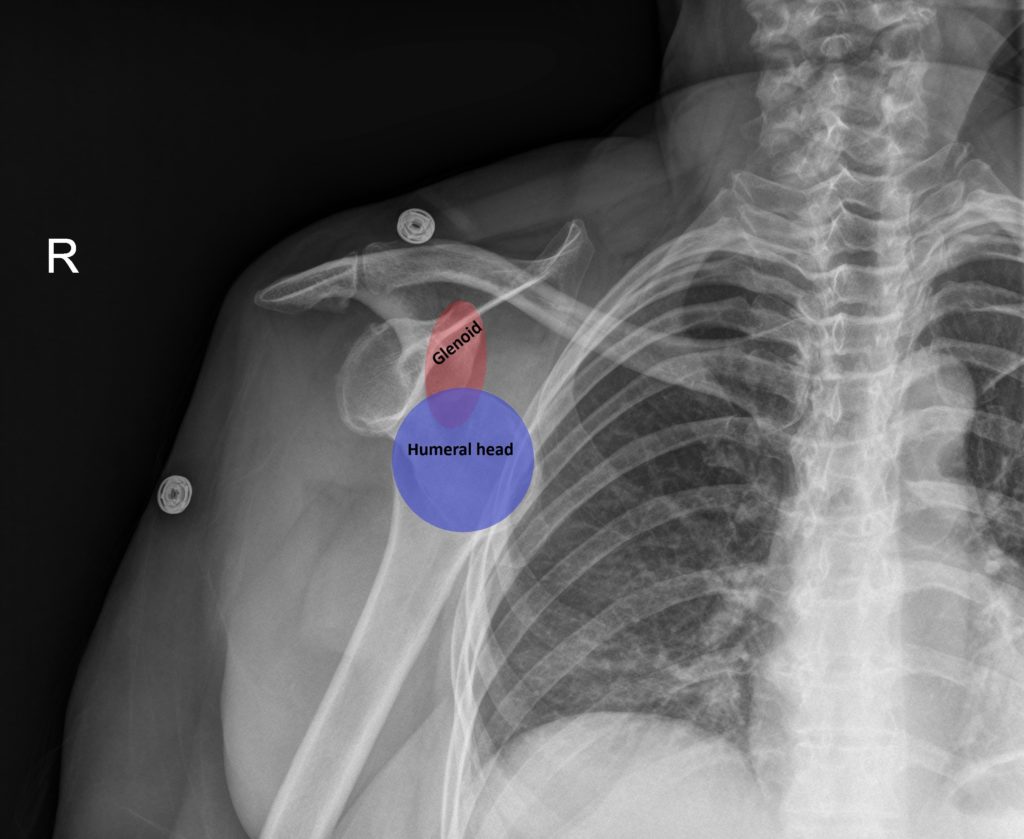 Anterior Shoulder Dislocation PreReduction AP XRay Annotated JETem Anterior Shoulder Dislocation PreReduction AP XRay Annotated JETem