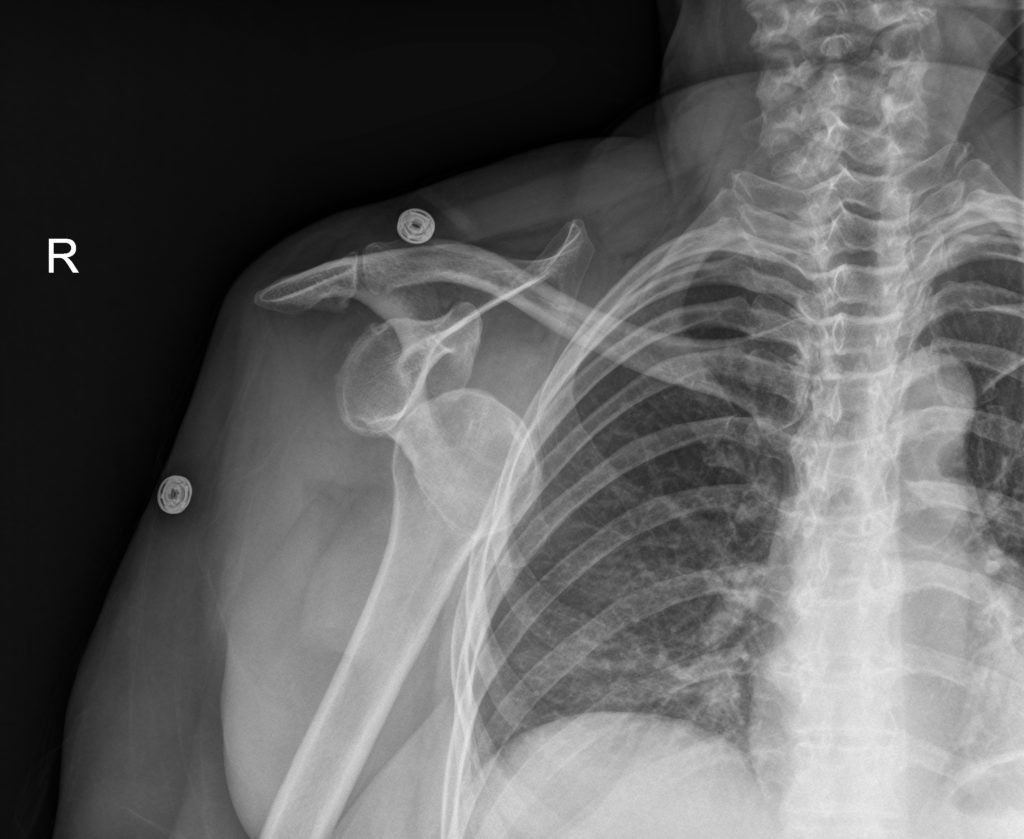 Diagnosis and Treatment of an Anterior Shoulder Dislocation with ...