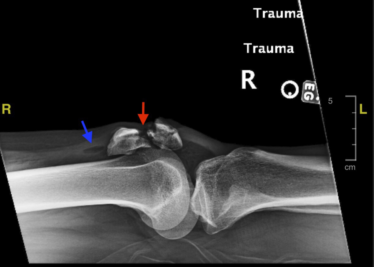 Open Fracture Of The Patella JETem Open Fracture Of The Patella JETem