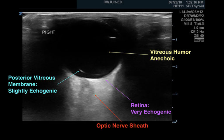 Posterior Vitreous Detachment, US 1, Annotated. JETem 2019 - JETem