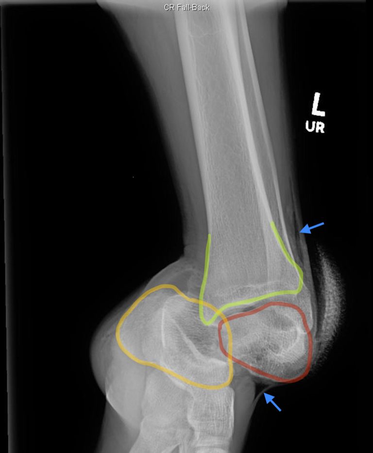 Open Subtalar Dislocation - JETem