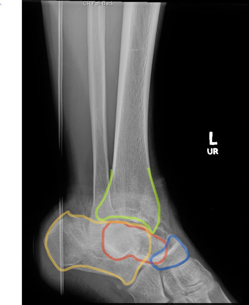 Open Subtalar Dislocation - JETem
