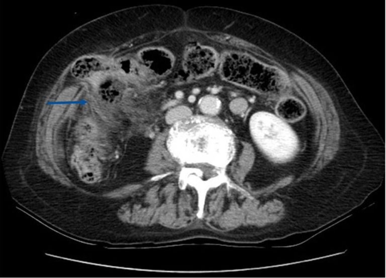 Incarcerated Ventral Hernia of T-colon Resulting in Colon Perforation ...
