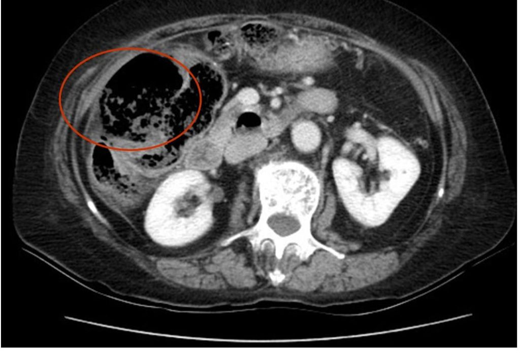 Incarcerated Ventral Hernia of T-colon Resulting in Colon Perforation ...