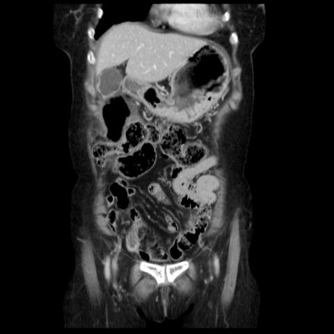 Incarcerated Ventral Hernia of T-colon Resulting in Colon Perforation ...