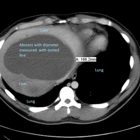 Right Upper Quadrant Pain in a World Explorer - JETem