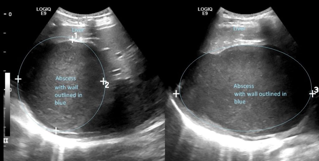 RUQ Pain, Liver Abscess. US 2, Annotated. JETem 2019 - JETem