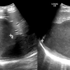 Right Upper Quadrant Pain in a World Explorer - JETem
