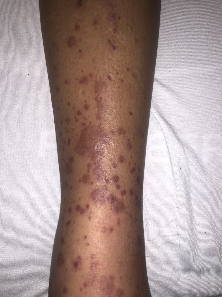 Henoch-Schönlein Purpura in the Adult - JETem