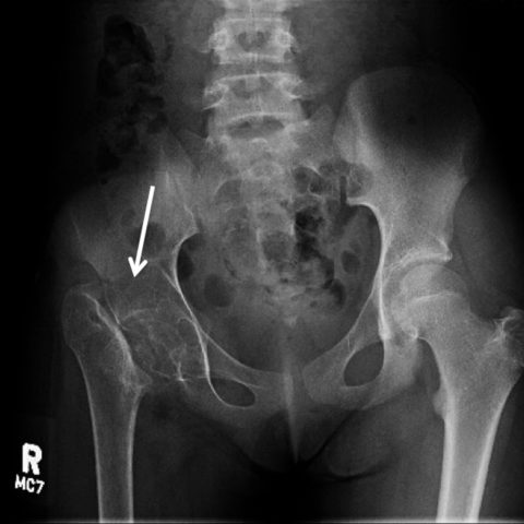 Case Report of Untreated Pediatric Femoral Neck Fracture with ...