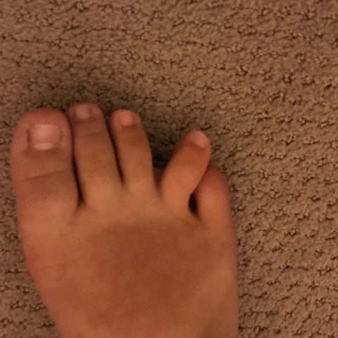 Digital Nerve Block for the Reduction of a Proximal Phalanx Fracture of ...