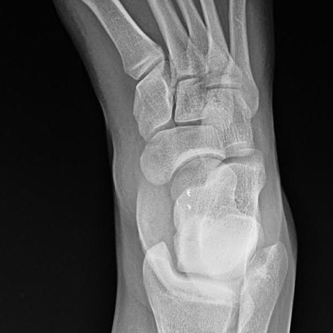 Digital Nerve Block for the Reduction of a Proximal Phalanx Fracture of ...