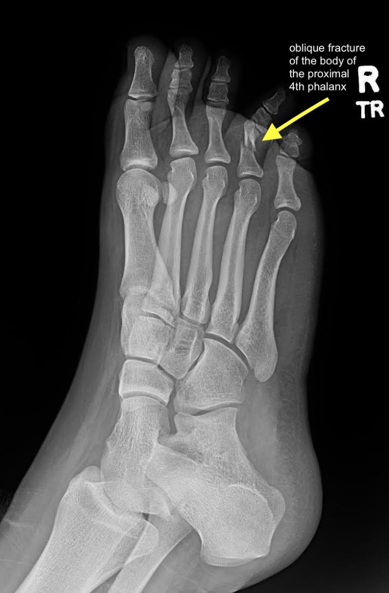 Xray Foot