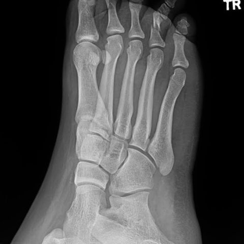 Digital Nerve Block for the Reduction of a Proximal Phalanx Fracture of ...