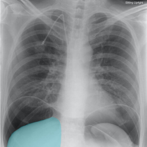 Loose PEG Tube Leading to Peristomal Leakage and Peritonitis - JETem