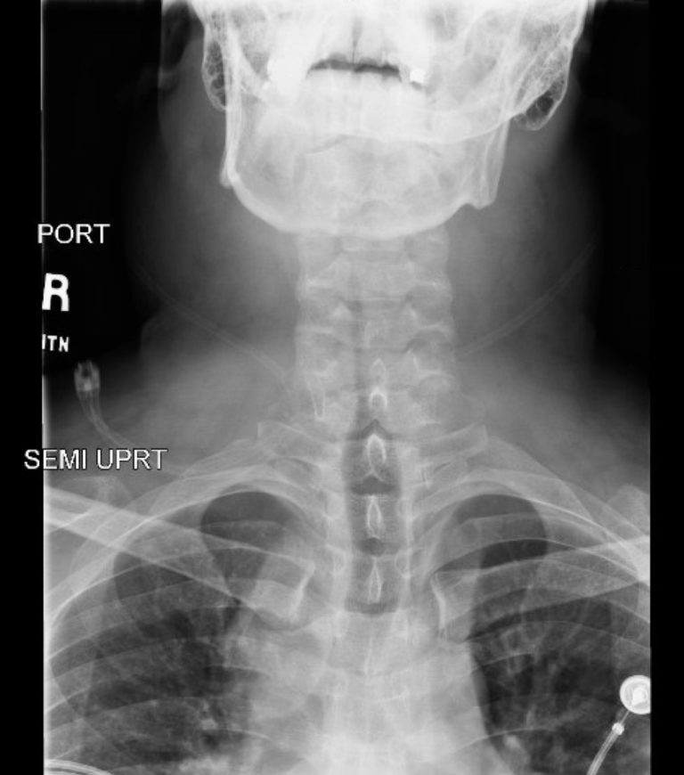 Loose PEG Tube Leading to Peristomal Leakage and Peritonitis - JETem
