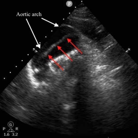 Ascending Thoracic Aortic Dissection: A Case Report of Rapid Detection ...