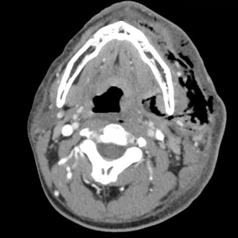 Auricular Perichondritis after a “High Ear Piercing:” A Case Report - JETem
