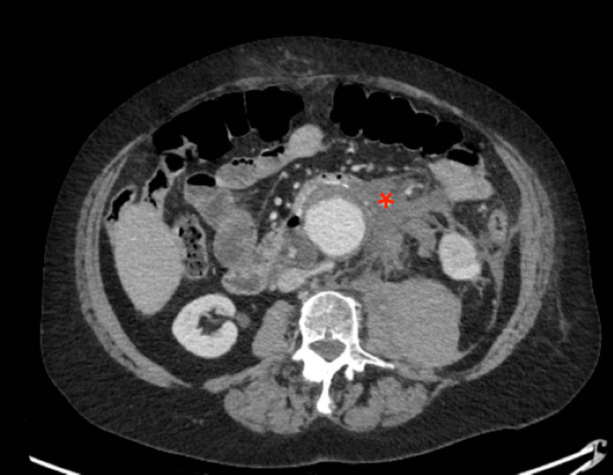 Ruptured Stable AAA CT Transverse 1, Annoated. JETem 2020 - JETem