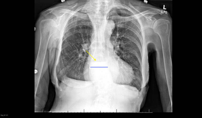 X-ray Esophageal Food Boluses. CXR Annotated. JETem 2020 - JETem