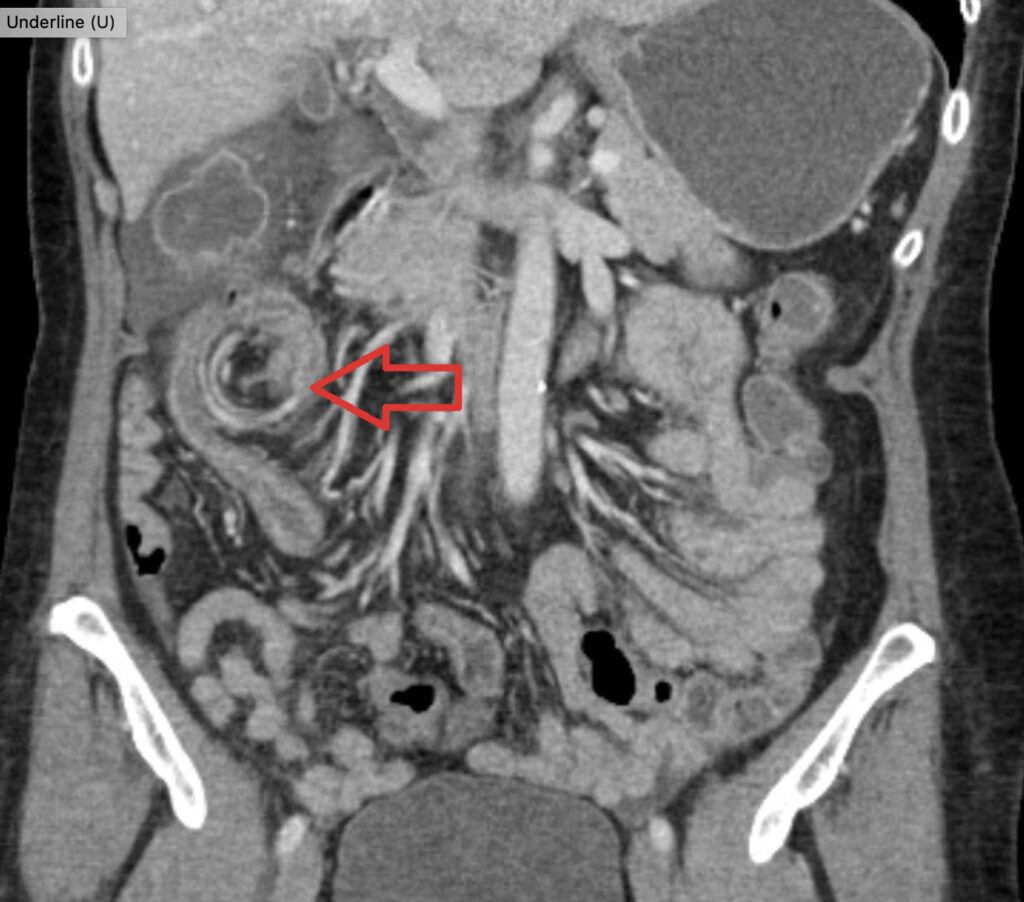Cecal Volvulus with Whirl Sign. CT. Annotated. JETem 2020 - JETem