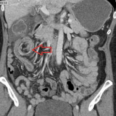 Cecal Volvulus Diagnosed with a Whirl Sign: A Case Report - JETem