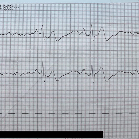 Paroxysmal Ventricular Standstill—A Case Report of all Ps and no QRS in ...