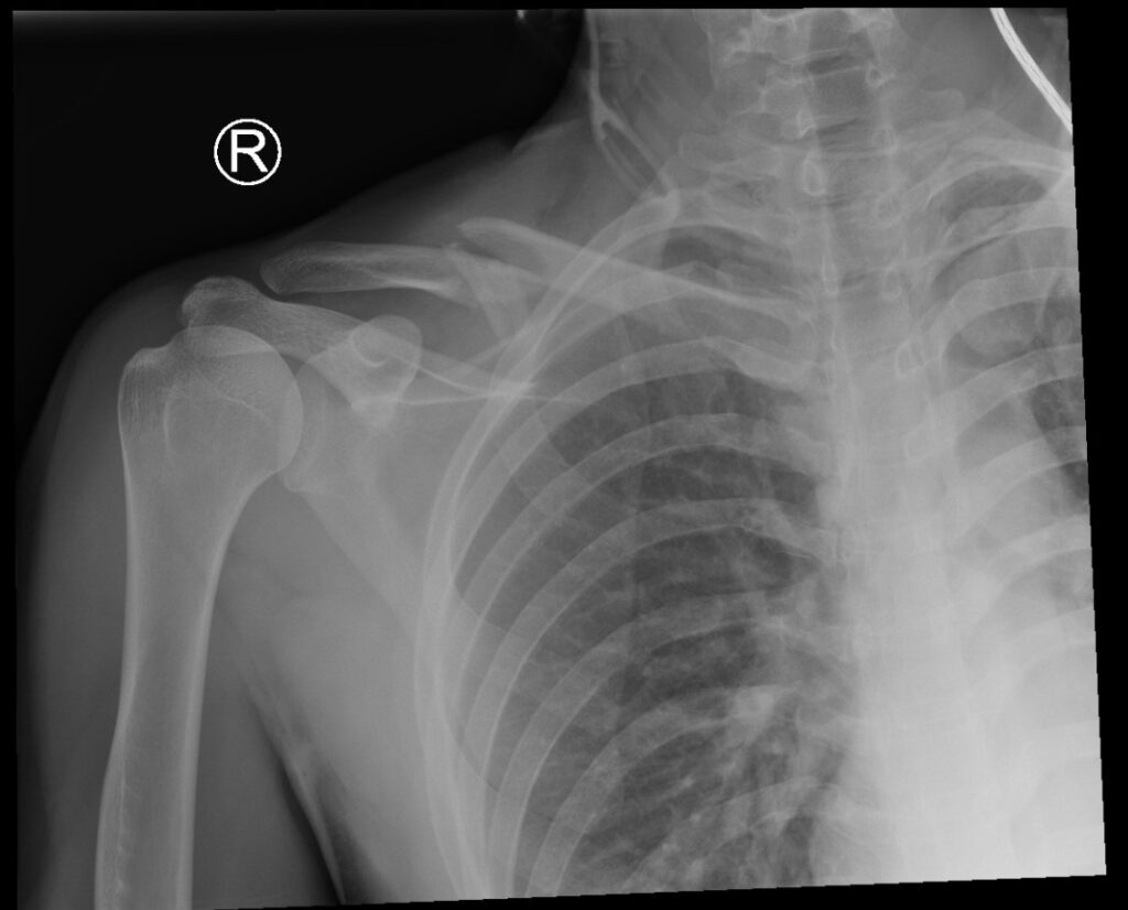 R Clavicular Fracture 1 Day XRay. Unannoatated. JETem 2020 - JETem