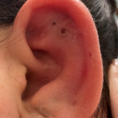 Auricular Perichondritis after a “High Ear Piercing:” A Case Report - JETem