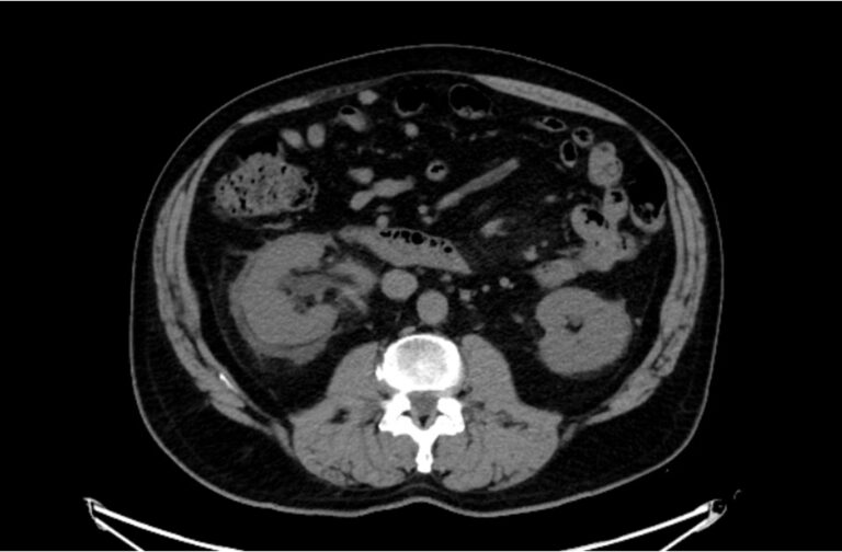 Not Your Typical Kidney Stone. Forniceal Rupture 2. CT. Unannotated ...