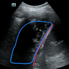 Case Report of an Empyema Identified on Lung Ultrasound - JETem