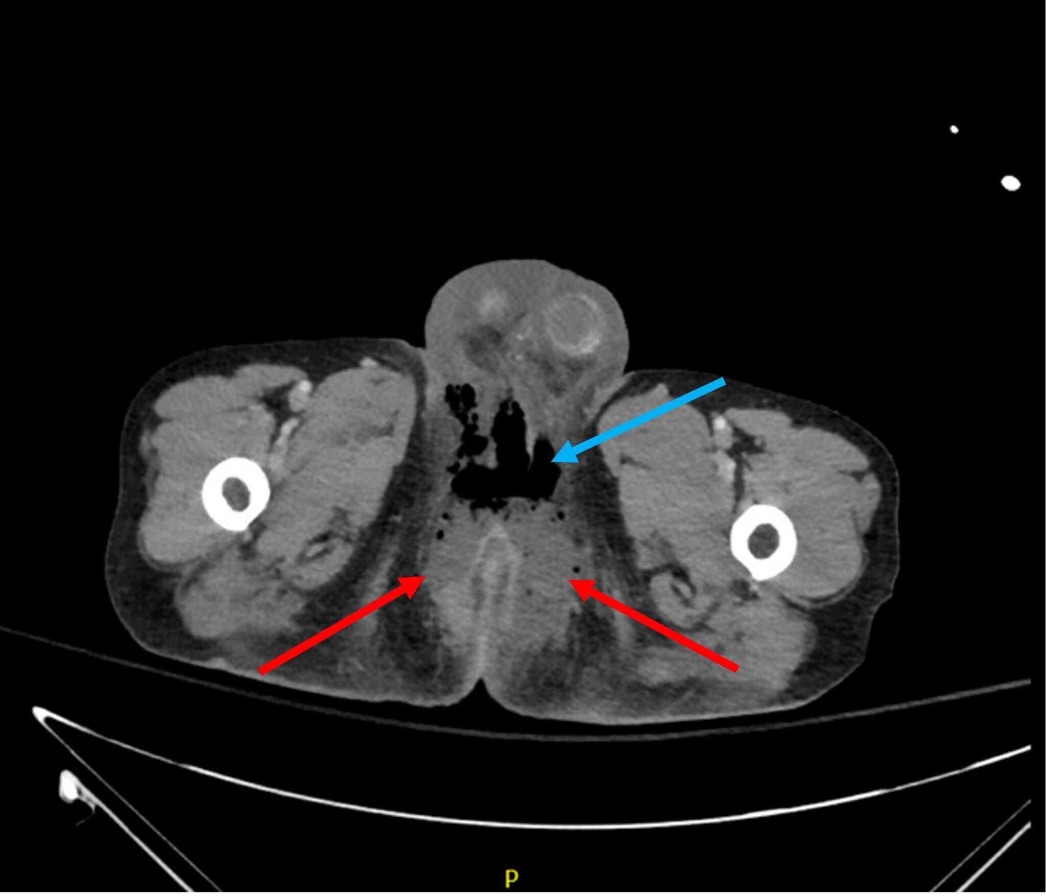 Fournier’s Gangrene CT Annotated. JETem 2022 - JETem